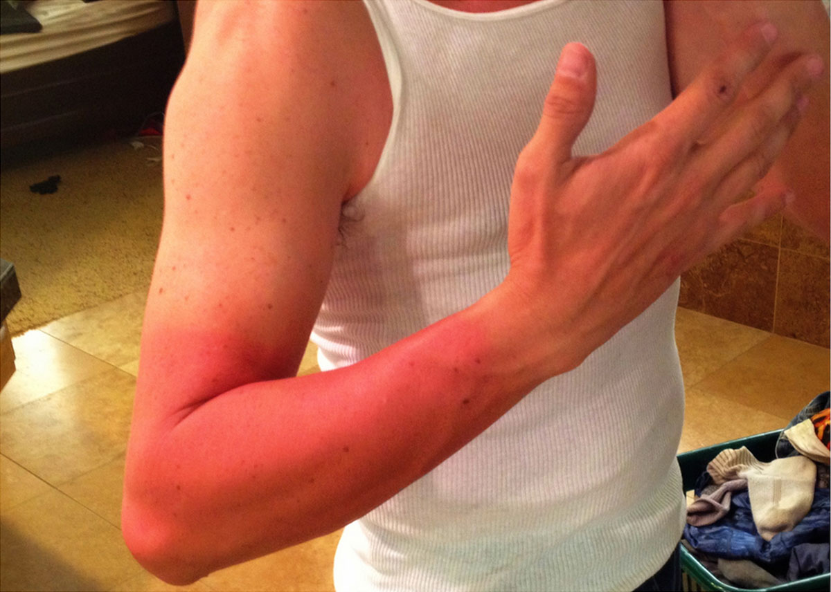 Skin Protection Should be a Priority | OSHA Safety Manuals